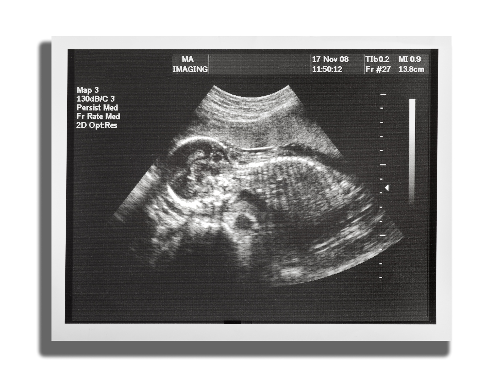 Gather Components For OB Ultrasound Codes 76805 And 76811 AAPC