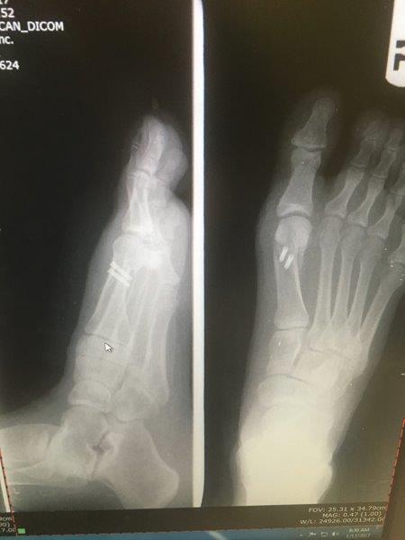 What Is The Cpt Code For Austin Bunionectomy