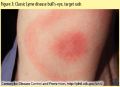 The More You Know About Lyme Disease the Easier It Is to Code - AAPC ...