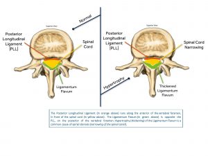 ICD-10-PCS Coding for Lumbar Spinal Fusion - AAPC Knowledge Center