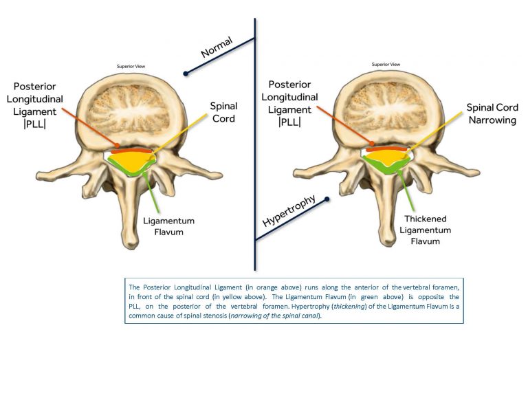 Bone Up on Lumbar Spinal Fusion - AAPC Knowledge Center