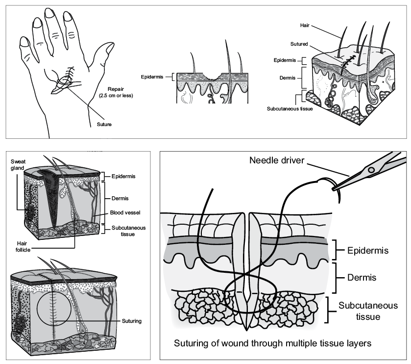 Wound Repair Coding in 3 Easy Steps - AAPC Knowledge Center