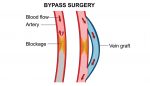 CABG: Bypass Problematic Coding Scenarios - AAPC Knowledge Center