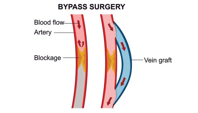 CABG: Bypass Problematic Coding Scenarios - AAPC Knowledge Center