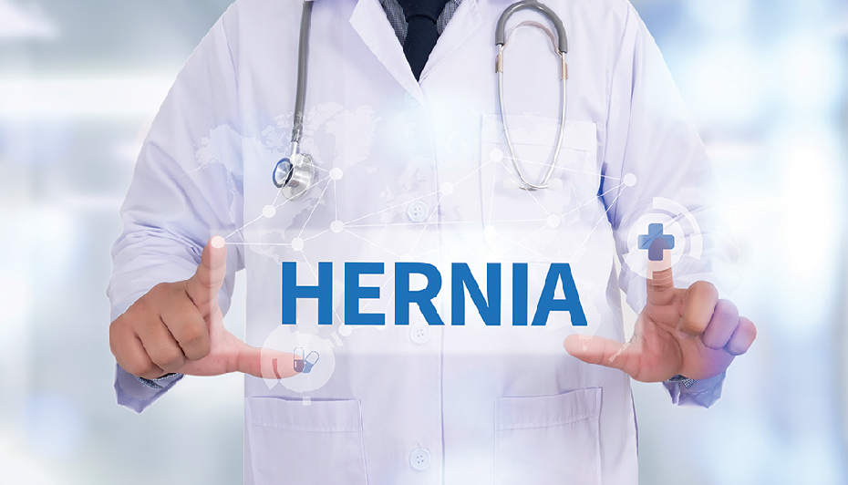 Icd 10 Code For Bilateral Direct Inguinal Hernias Icd 10 Code For Bilateral Direct Inguinal Hernias