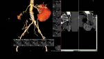 Coding Complex Vascular Cases - AAPC Knowledge Center