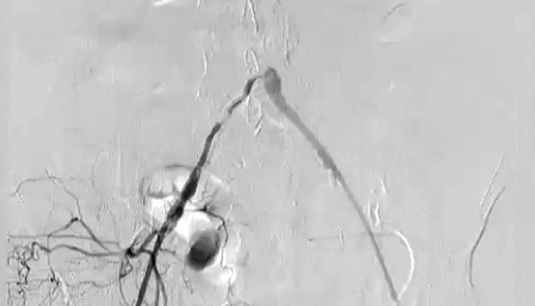Coding Complex Vascular Cases - AAPC Knowledge Center Coding Complex Vascular Cases - AAPC Knowledge Center