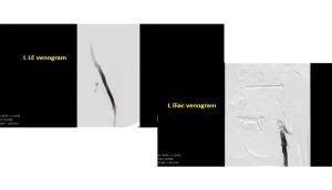 Coding Complex Vascular Cases - AAPC Knowledge Center