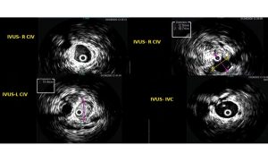 Coding Complex Vascular Cases - AAPC Knowledge Center