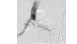 Coding Complex Vascular Cases - AAPC Knowledge Center