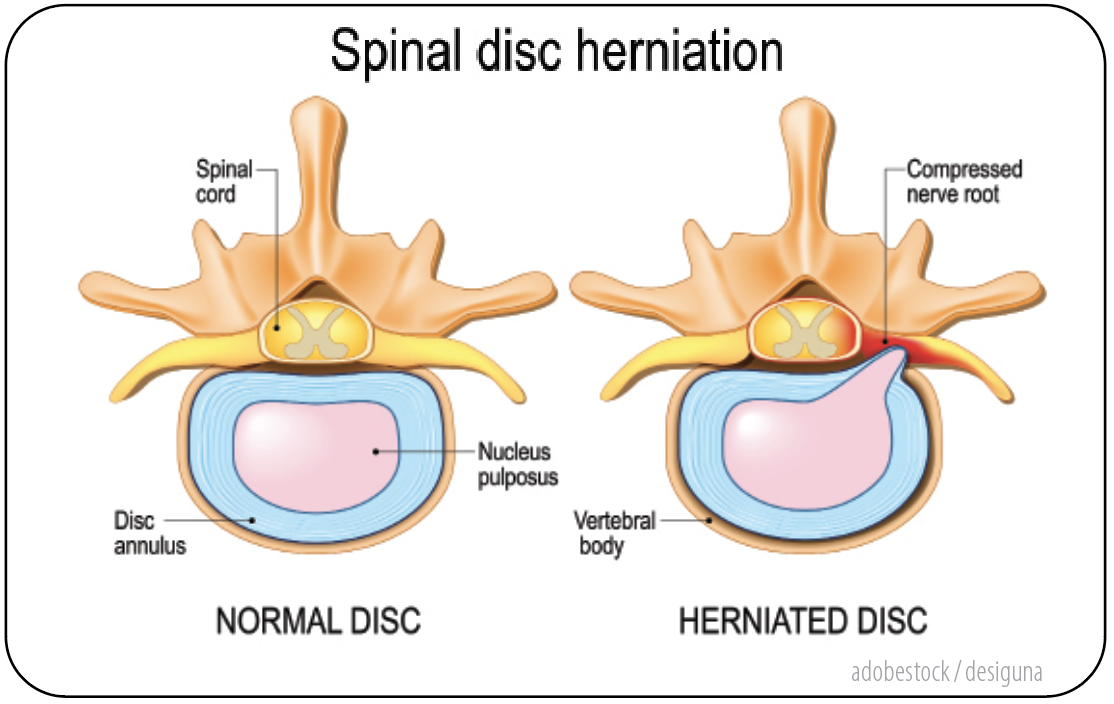 Closing the Coding Gap for Annular Defects - AAPC Knowledge Center