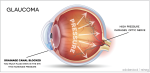 Get a Closer View of Glaucoma Coding - AAPC Knowledge Center