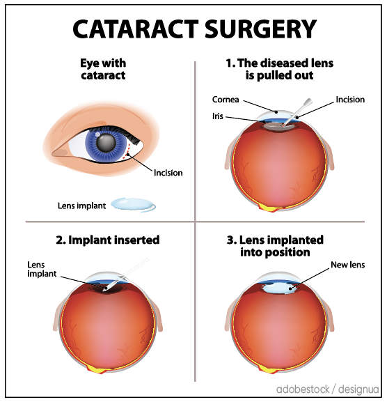 Code Cataract Surgery With Clarity AAPC Knowledge Center