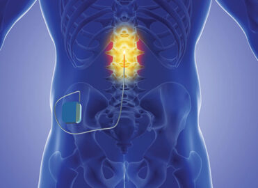 Getting Spinal Neurostimulators Approved - AAPC Knowledge Center